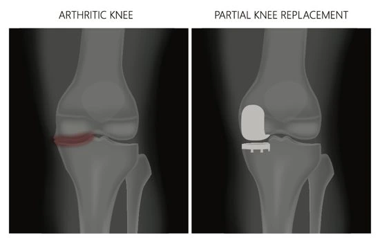 Partial Knee Replacement | UKR | Mr Sam Nahas